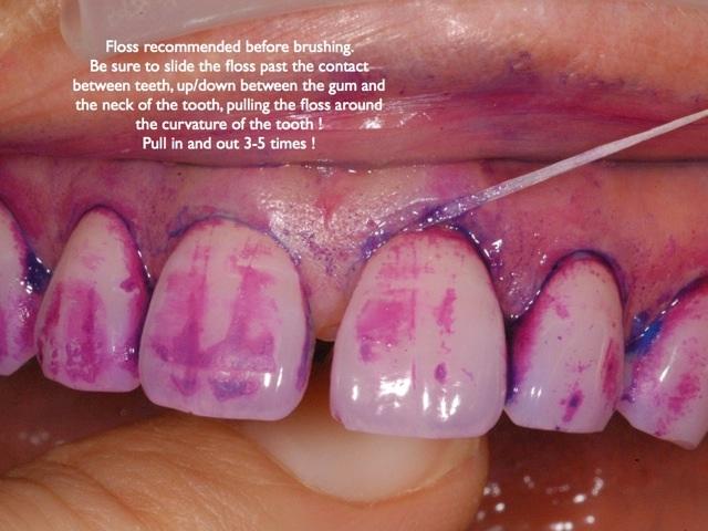 Dental Plaque Disclosing Gel Tooth Teeth Stain GC Tri | eBay